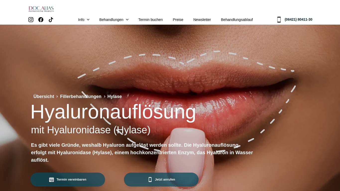 Hyaluron auflösen mit Hylase - bei Knötchen in den Lippen und Assymetrien